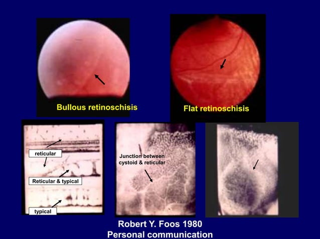 RETINOSCHISIS AND RETINAL DETACHMENT | PPT | Eye and Vision Conditions ...