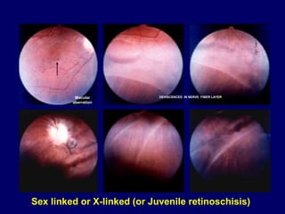 RETINOSCHISIS AND RETINAL DETACHMENT | PPT