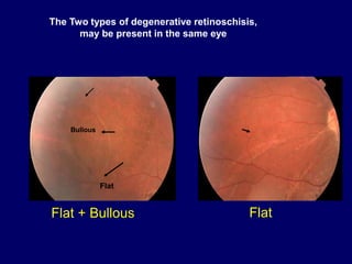 RETINOSCHISIS AND RETINAL DETACHMENT | PPT