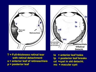 RETINOSCHISIS AND RETINAL DETACHMENT | PPT