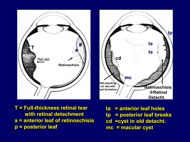 RETINOSCHISIS AND RETINAL DETACHMENT | PPT