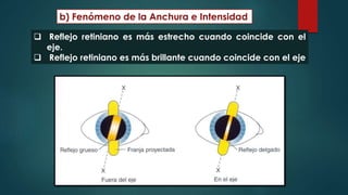 Retinoscopía | PPTX
