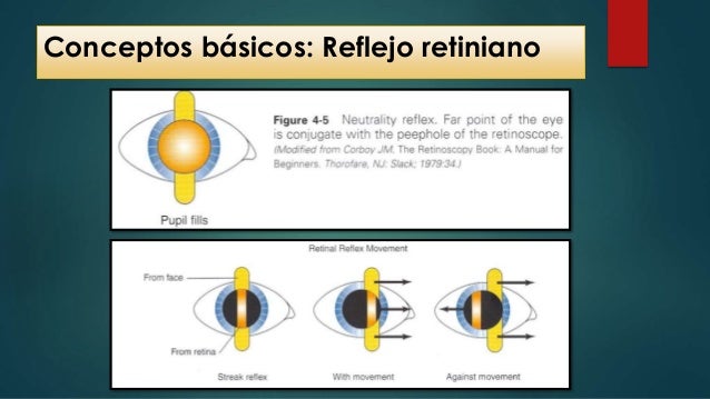 Retinoscopía