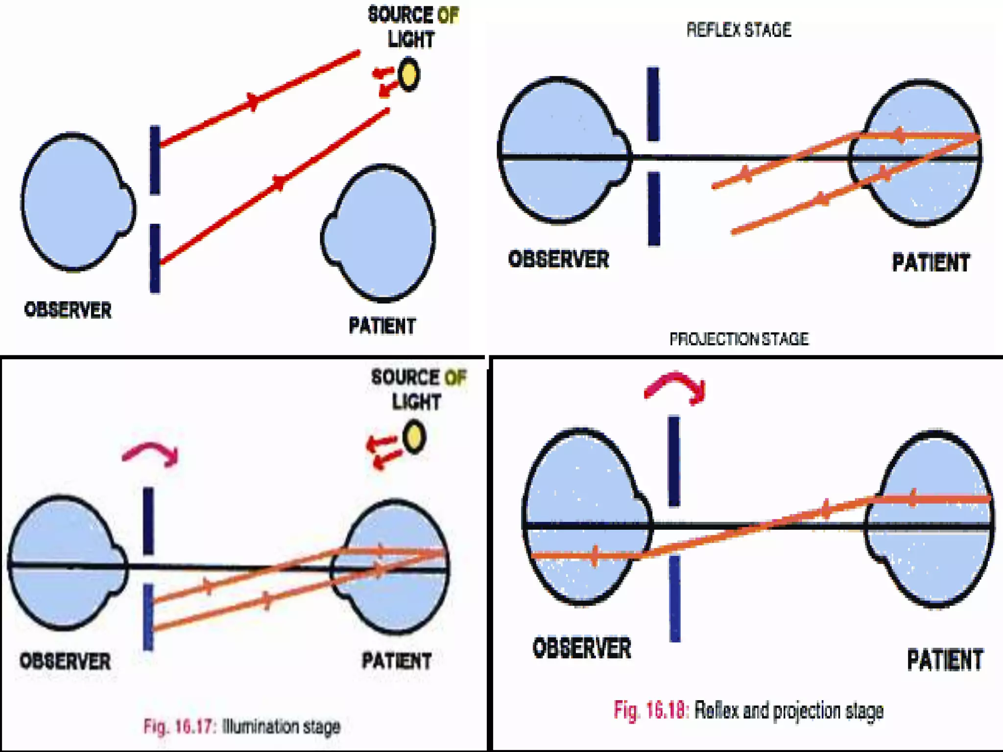 Retinoscopy | PPT