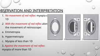 Retinoscopy ophthalmology procedure cycloplegic observation ...