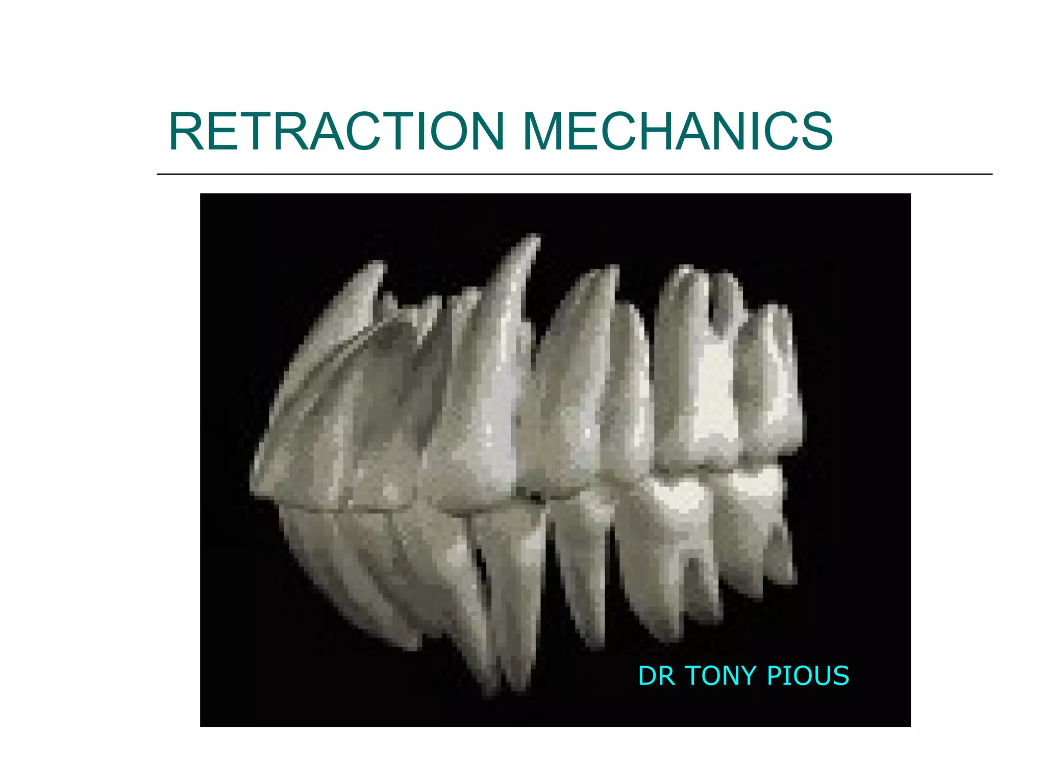 Retraction mechanics | PPT