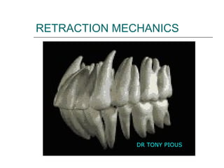 Retraction mechanics | PPT