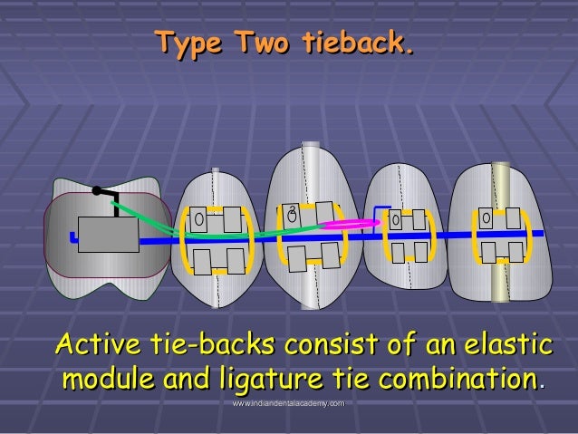 Retraction mechanics in swa 2 /certified fixed orthodontic courses by…
