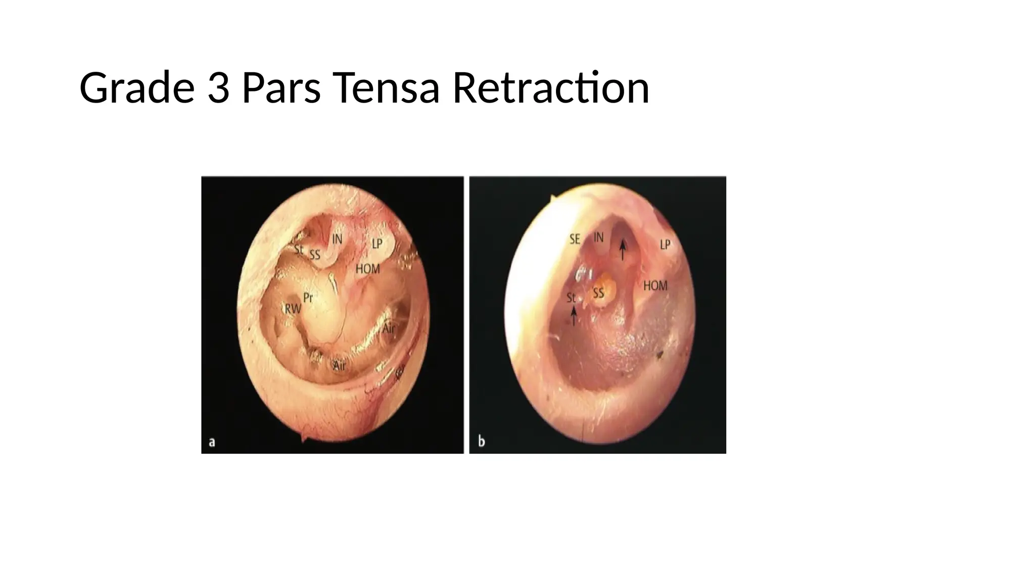 Retraction Pocket in Ear Cholesteatoma.pptx | Ear, Nose and Throat Conditions | Diseases and ...