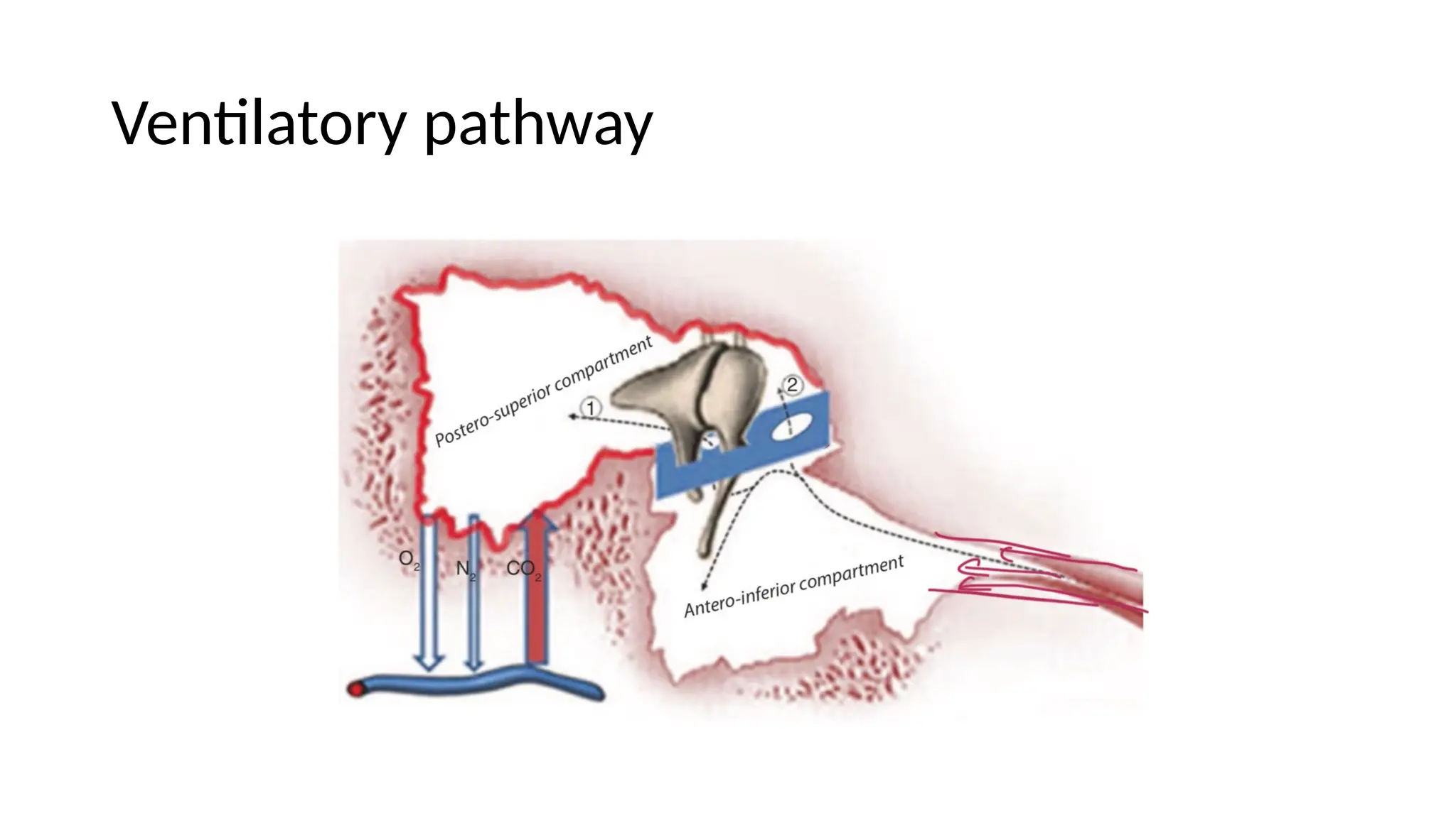 Retraction Pocket in Ear Cholesteatoma.pptx