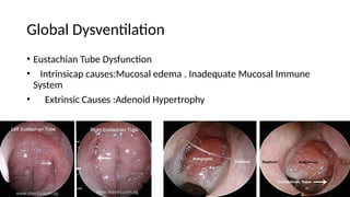 Retraction Pocket in Ear Cholesteatoma.pptx | Ear, Nose and Throat ...