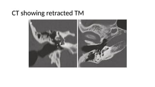 Retraction Pocket in Ear Cholesteatoma.pptx | Ear, Nose and Throat ...