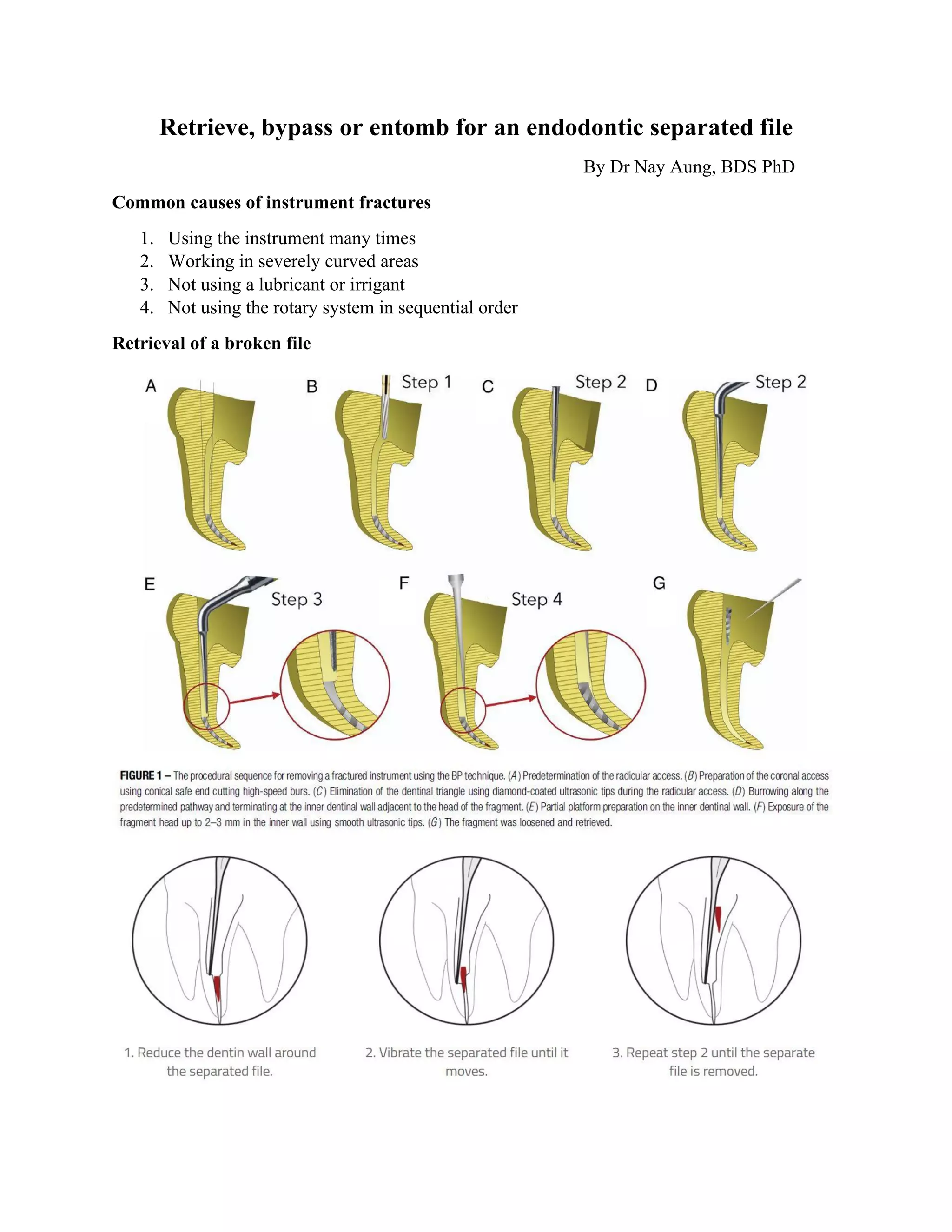 Retrieve, bypass or entomb for an endodontic separated file | PDF