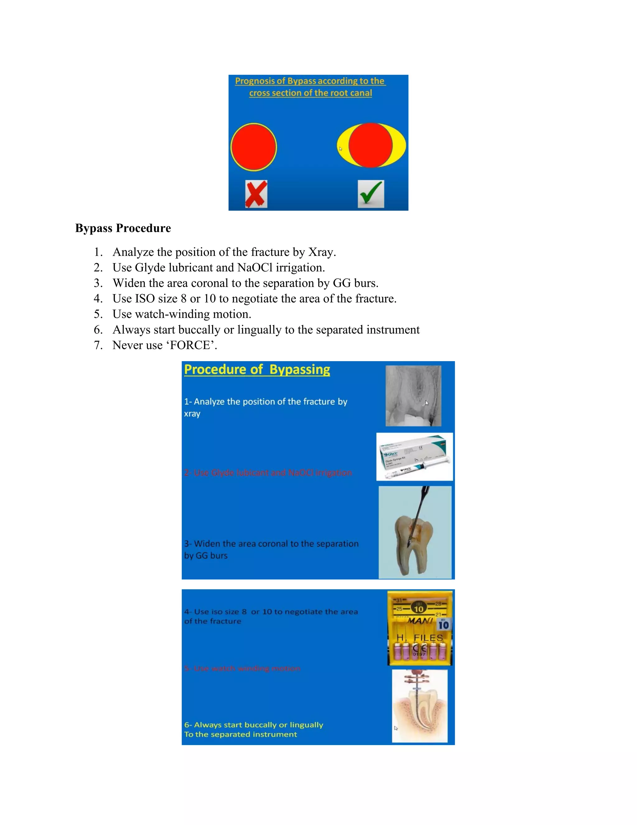 Retrieve, bypass or entomb for an endodontic separated file | PDF