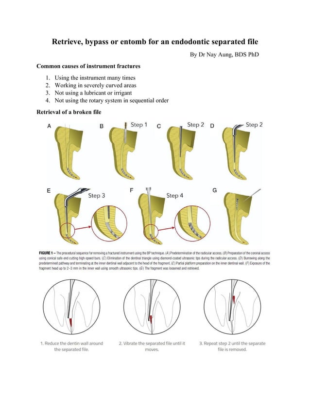 Retrieve, bypass or entomb for an endodontic separated file | PDF ...