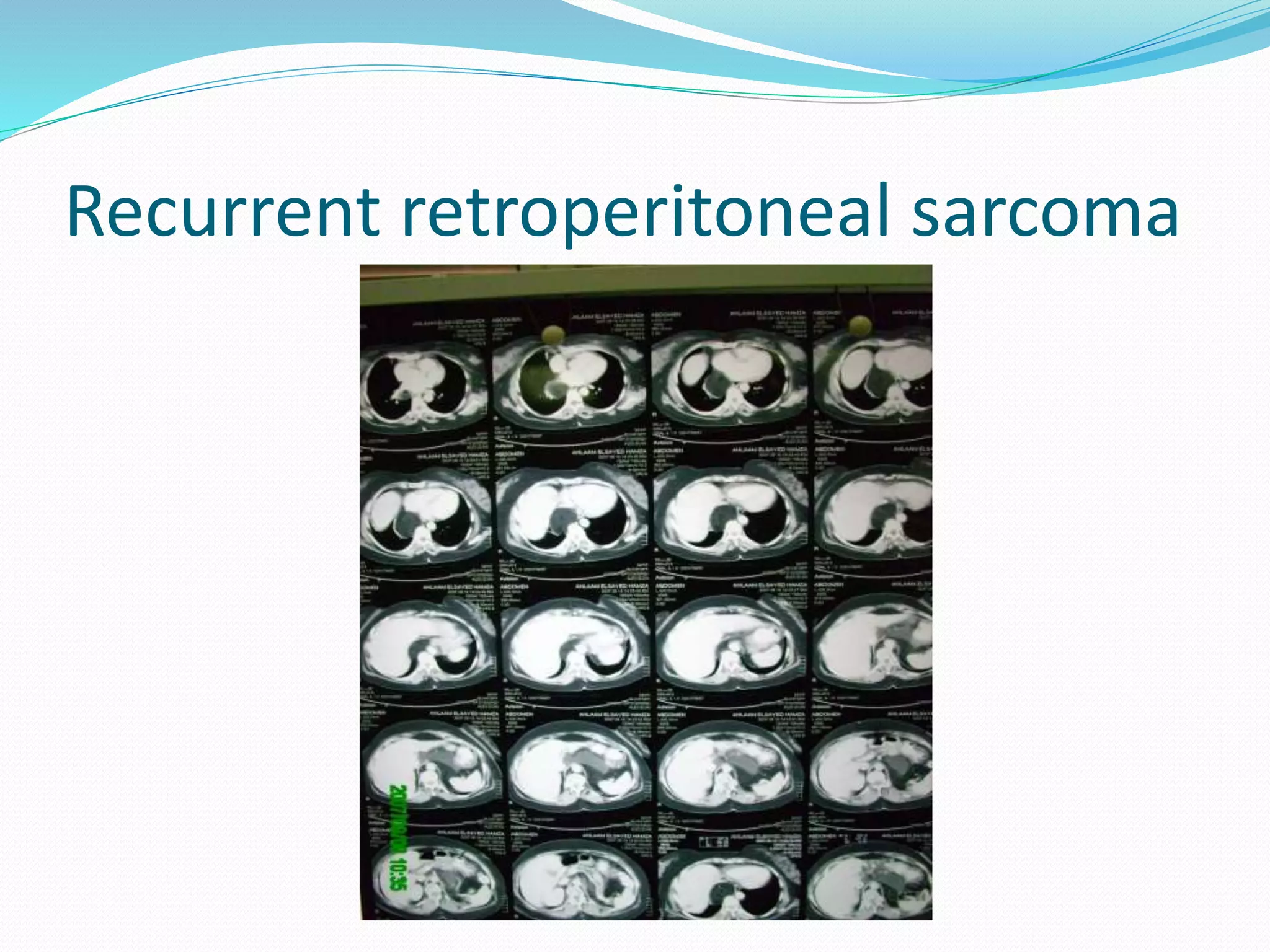 Retro peritoneal sarcoma | PPTX