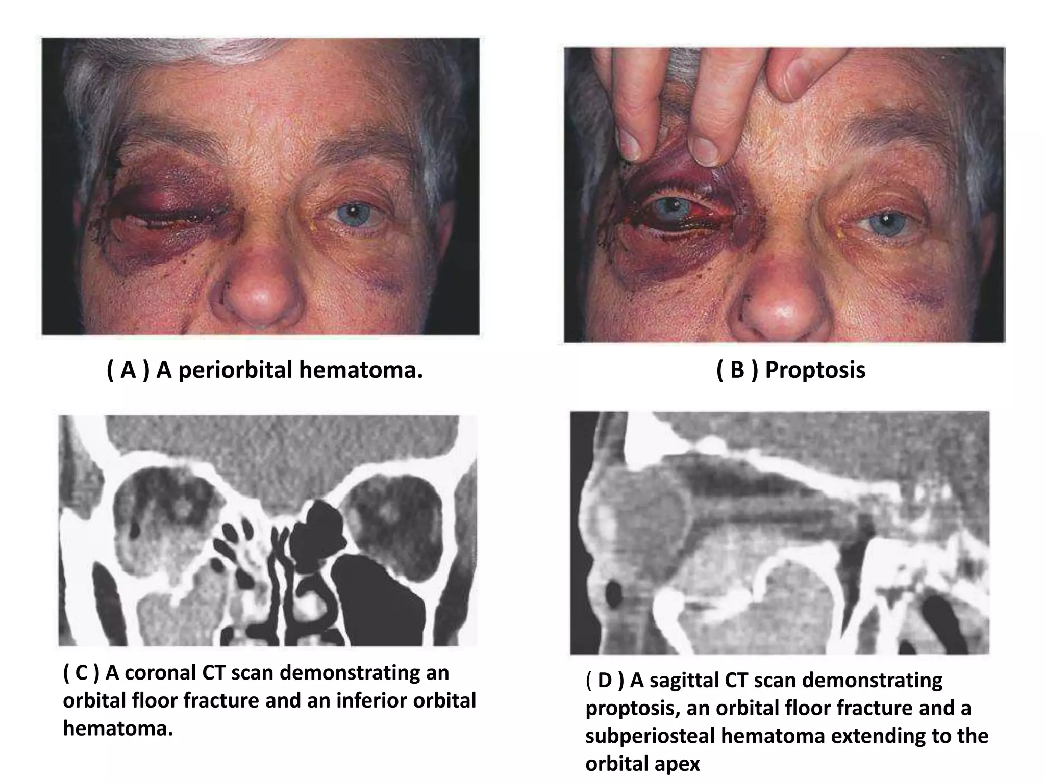 Retrobulbar haemorrhage | PPTX