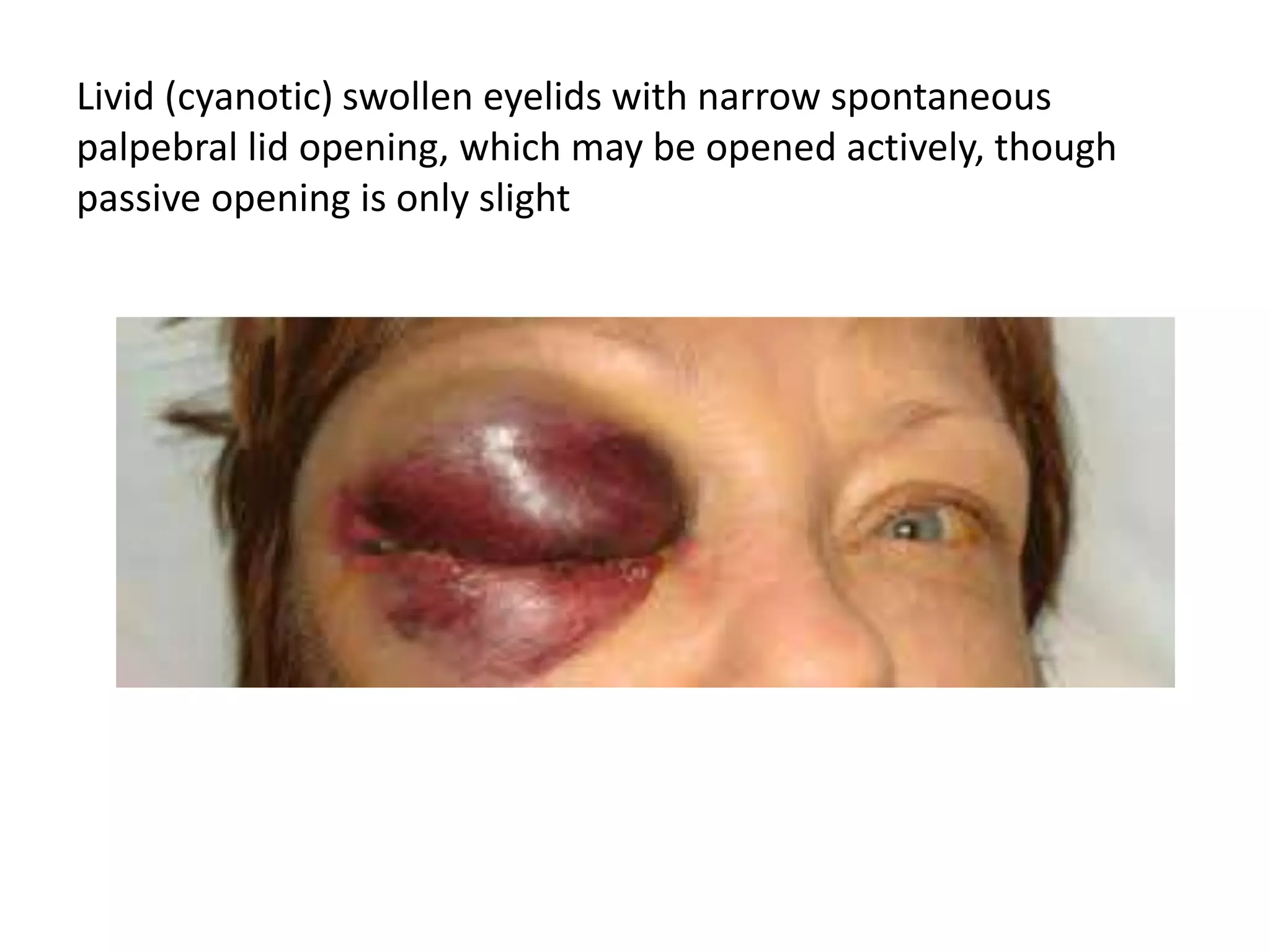 Retrobulbar haemorrhage | PPTX