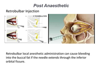 Retrobulbar haemorrhage | PPTX