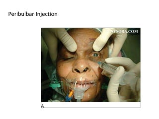 Retrobulbar haemorrhage | PPTX