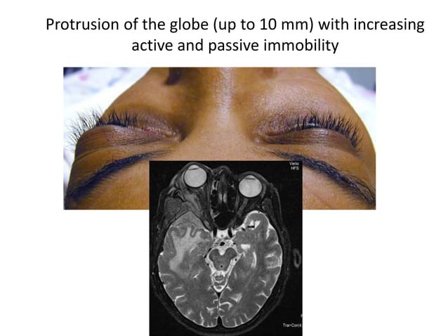 Retrobulbar haemorrhage | PPTX