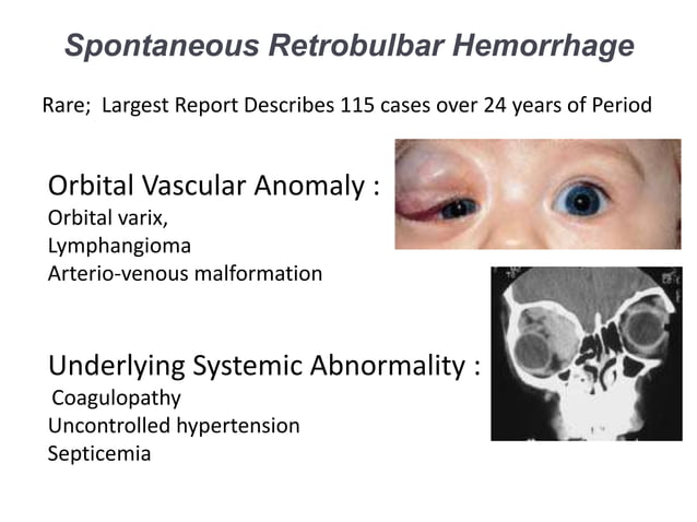 Retrobulbar haemorrhage | PPTX