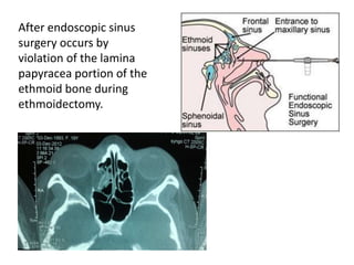 retrobulbar hemorrhage - anatomy physiology.pptx | Eye and Vision ...
