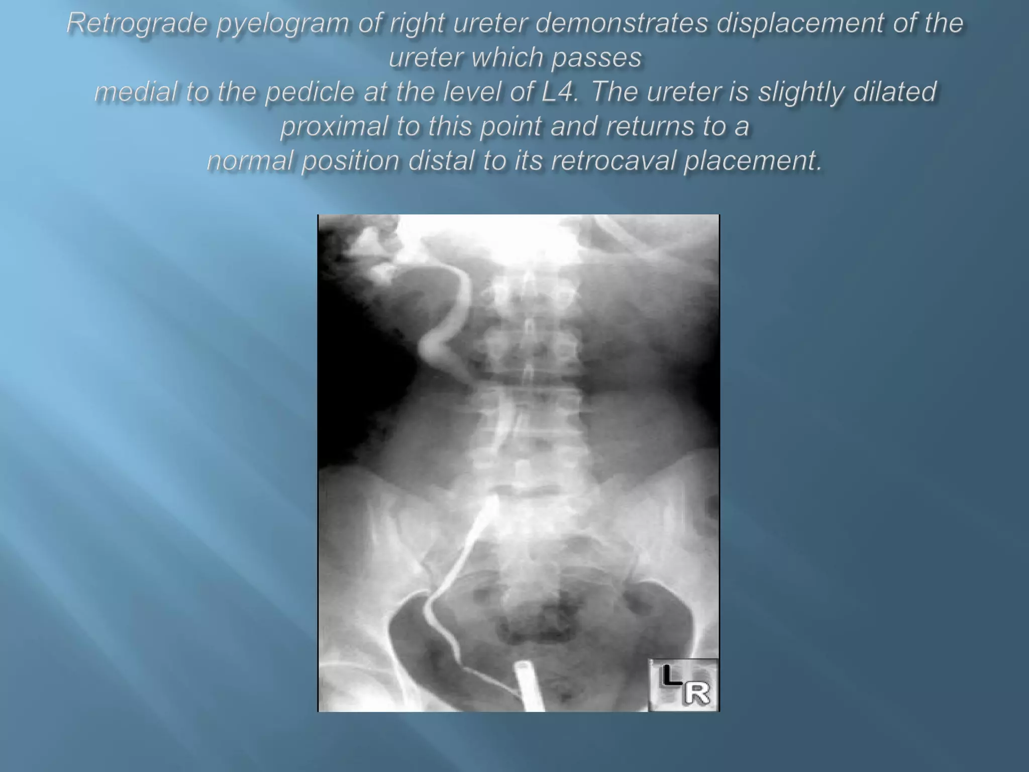 Retrocaval ureter | PPT