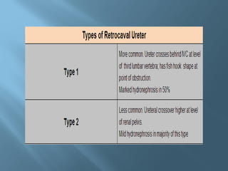 Retrocaval ureter | PPT