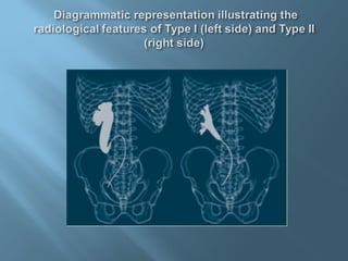 Retrocaval ureter | PPT