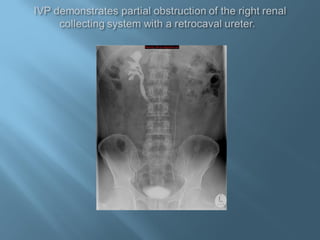 Retrocaval ureter | PPT