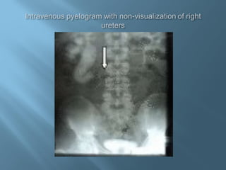 Retrocaval ureter | PPT