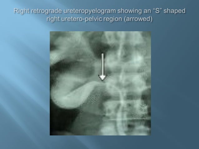 Retrocaval ureter | PPT