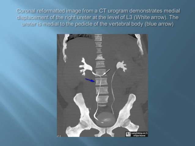 Retrocaval ureter | PPT