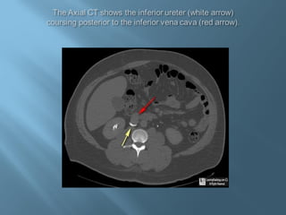 Retrocaval ureter | PPT