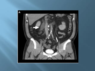 Retrocaval ureter | PPT