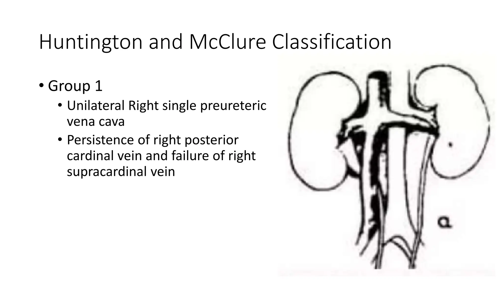 Retrocaval Ureter Urology Anatomy and Management | PPTX
