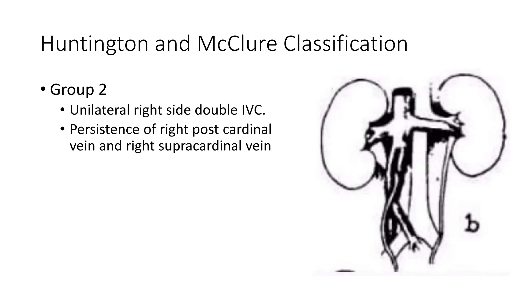 Retrocaval Ureter Urology Anatomy and Management | PPTX