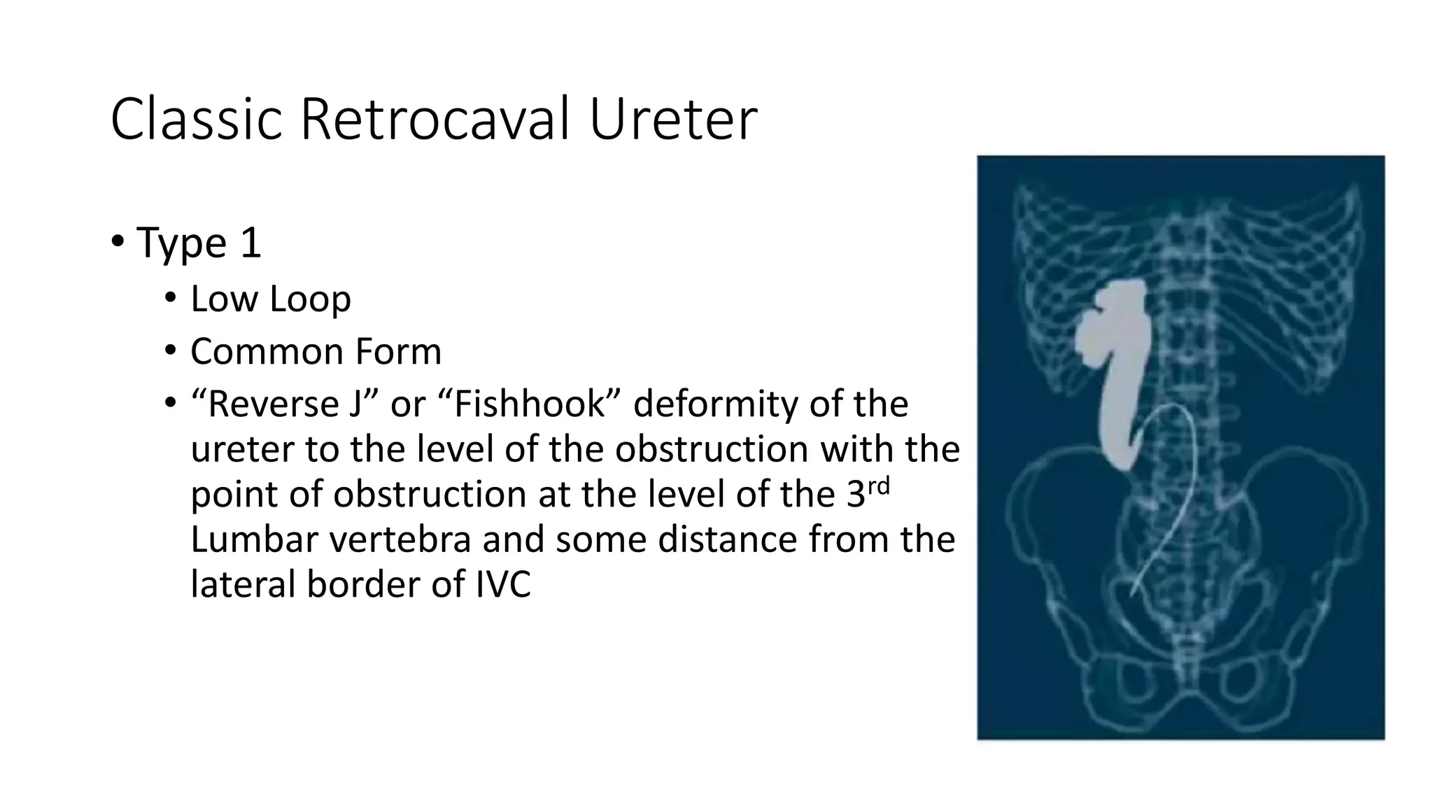 Retrocaval Ureter Urology Anatomy and Management | PPTX