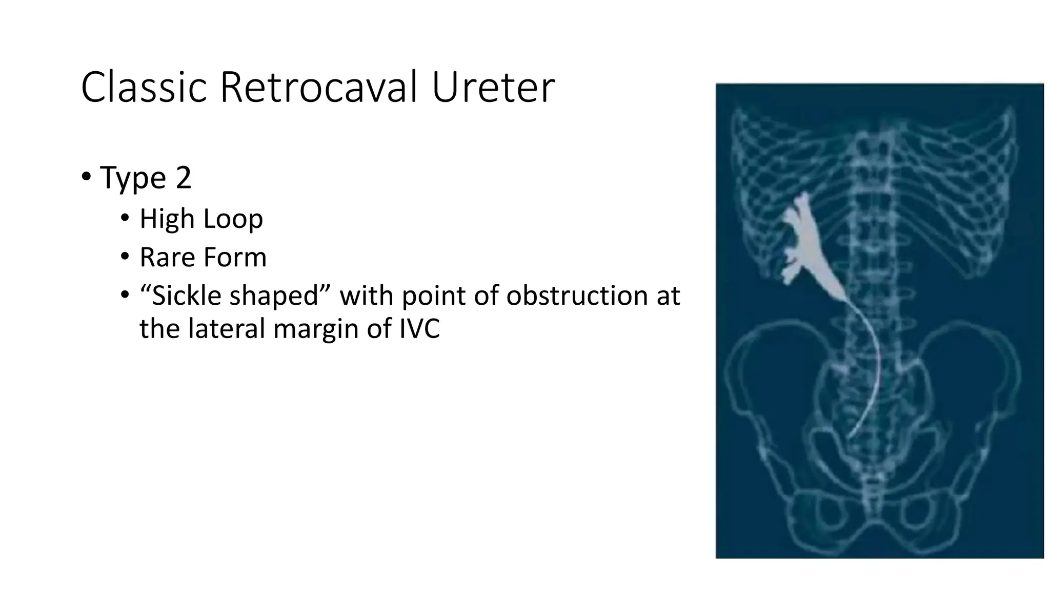 Retrocaval Ureter Urology Anatomy and Management | PPTX
