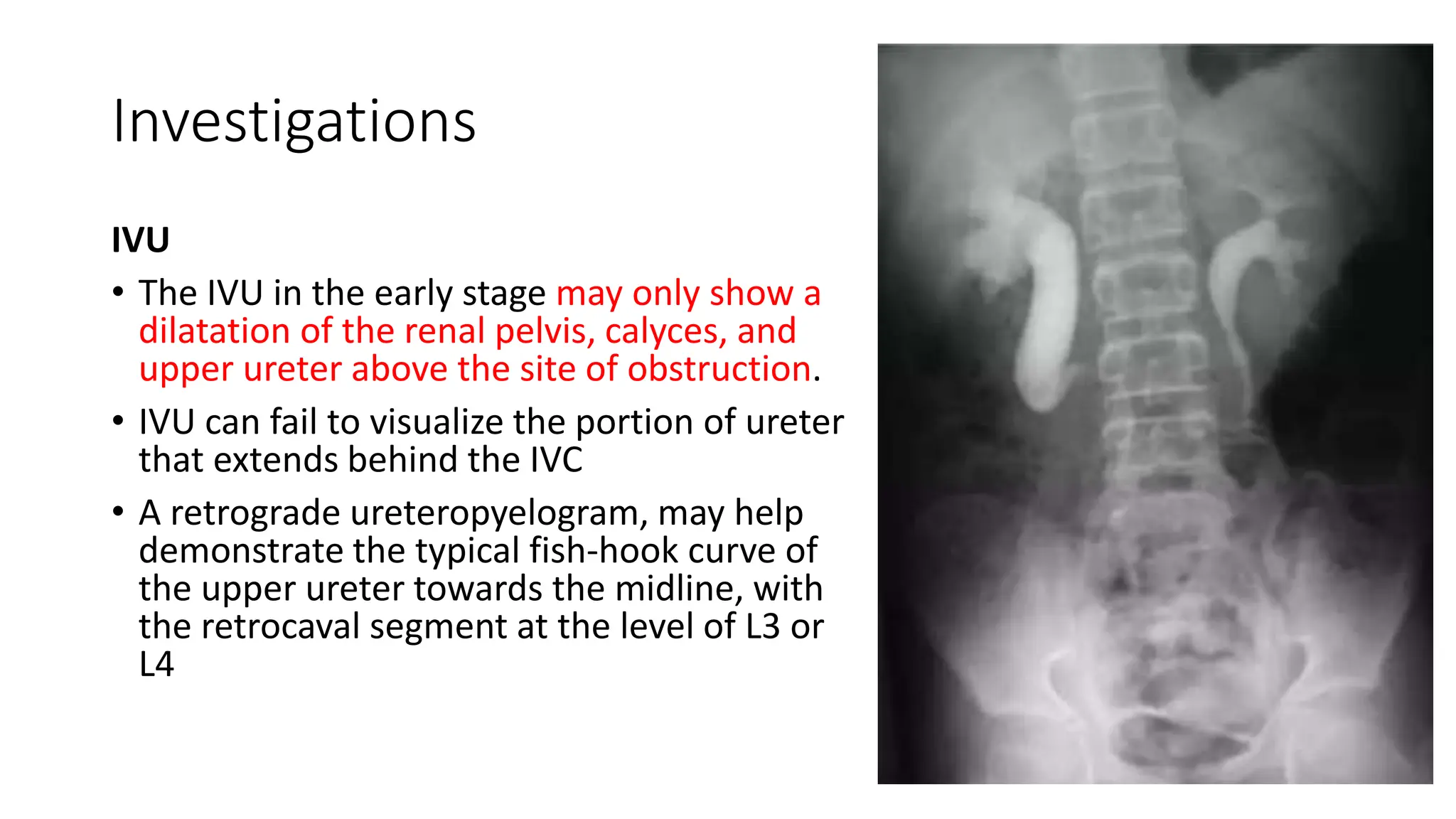 Retrocaval Ureter Urology Anatomy and Management | PPTX