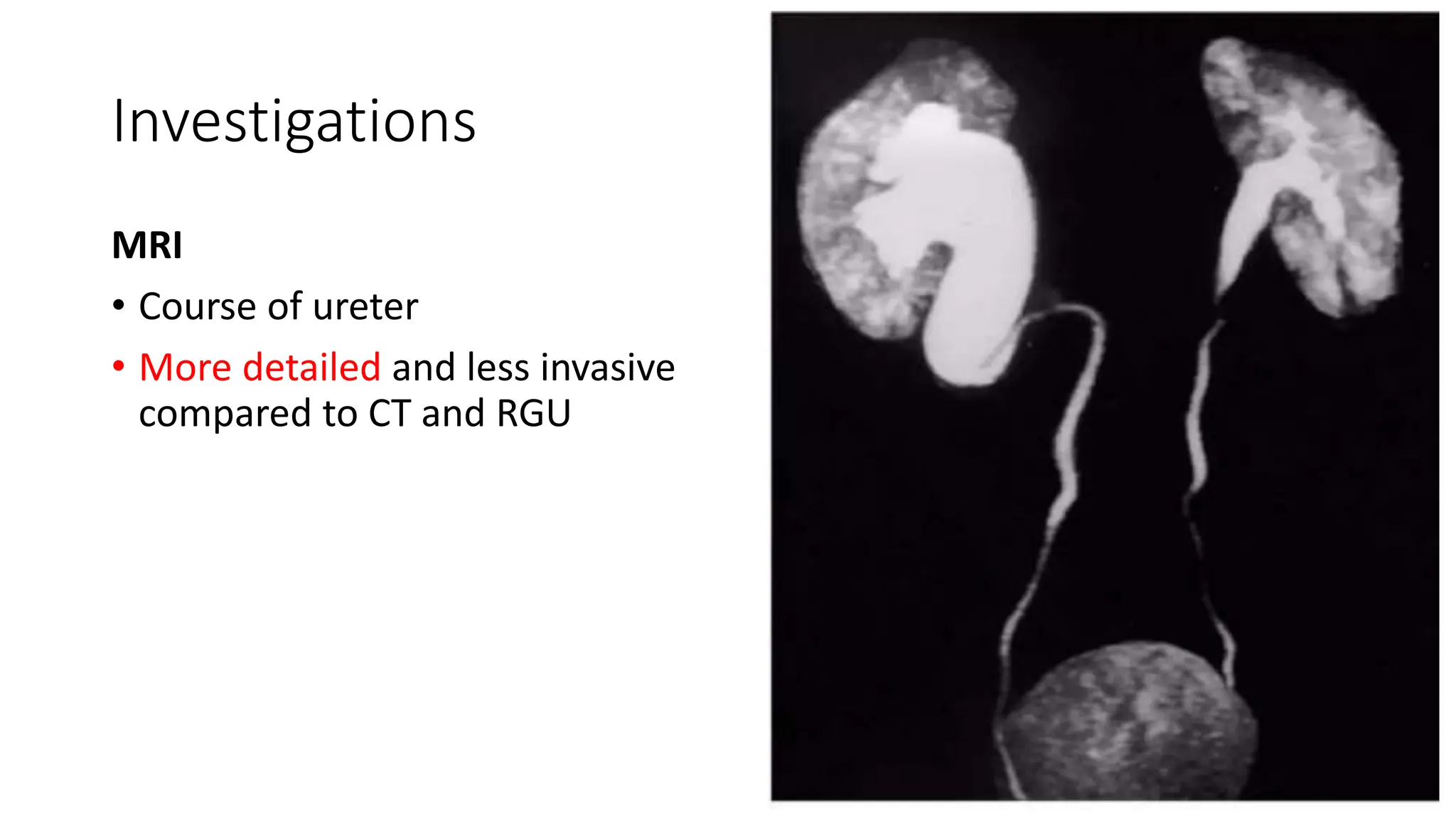 Retrocaval Ureter Urology Anatomy and Management | PPTX