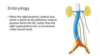 Retrocaval Ureter Urology Anatomy and Management | PPTX