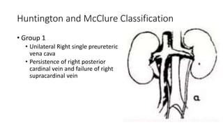 Retrocaval Ureter Urology Anatomy and Management | PPTX