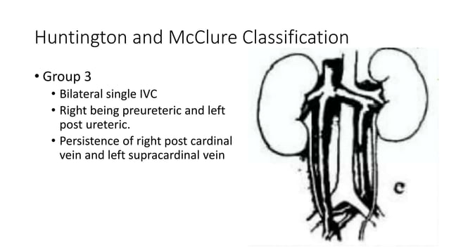 Retrocaval Ureter Urology Anatomy and Management | PPTX