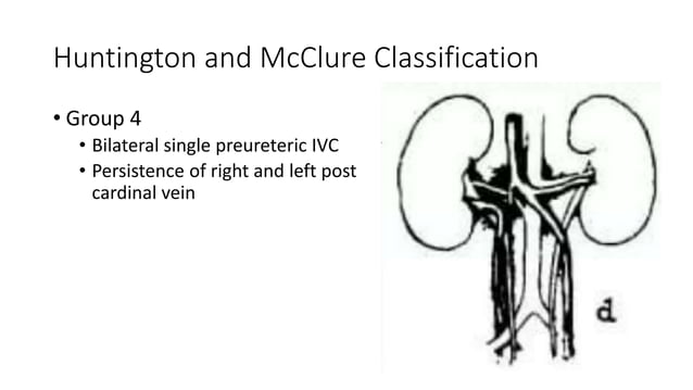 Retrocaval Ureter Urology Anatomy and Management | PPTX