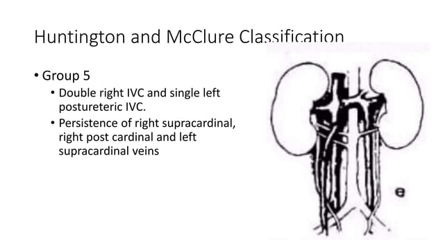 Retrocaval Ureter Urology Anatomy and Management | PPTX