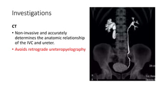 Retrocaval Ureter Urology Anatomy and Management | PPTX
