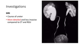 Retrocaval Ureter Urology Anatomy and Management | PPTX