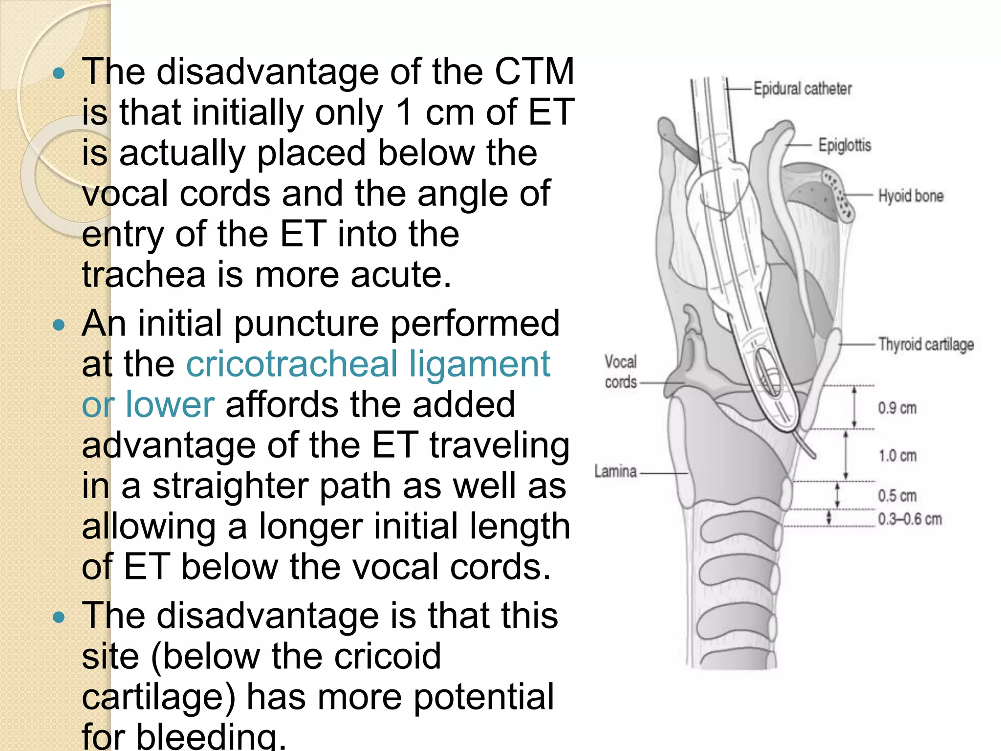 Retrograde intubation | PPTX